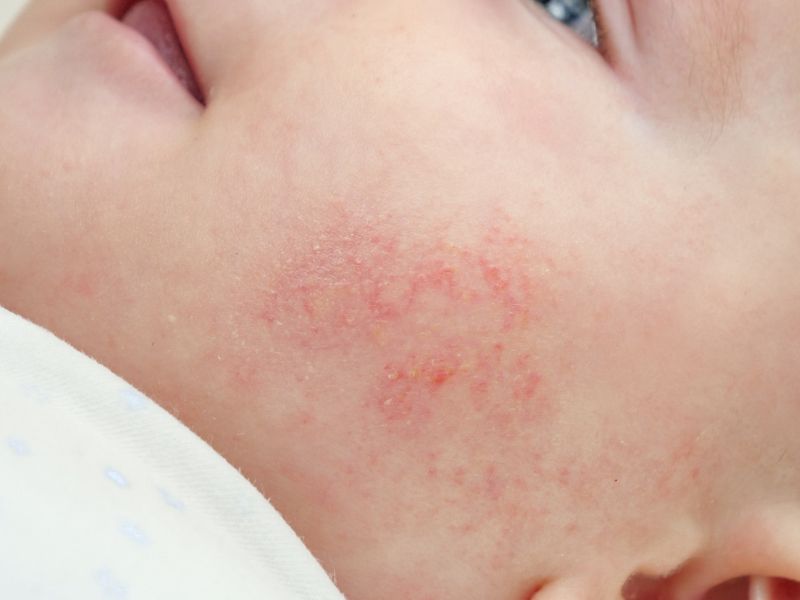 OK to Shop - Dermatitis atópica: sus causas y tratamientos